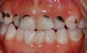 SDF consent form - Kids & Teens Dentistry